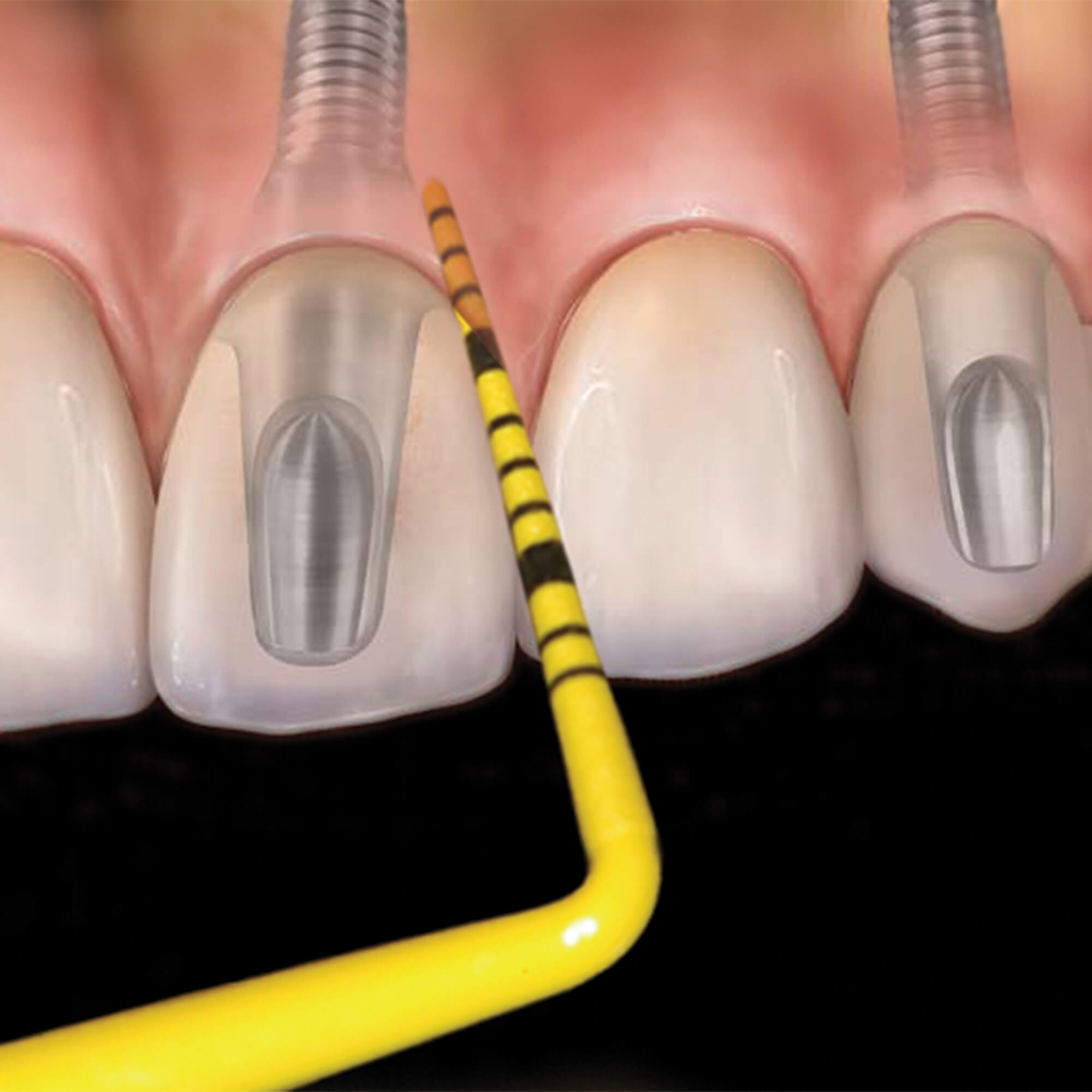 12 UNC Colorvue™ Probe Kit PCVNCKIT12 | HuFriedyGroup