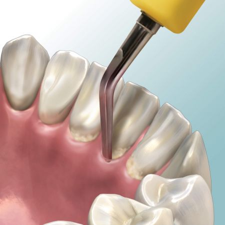 3 Beavertail Streamline™ Ultrasonic Insert UI325K | HuFriedy Group
