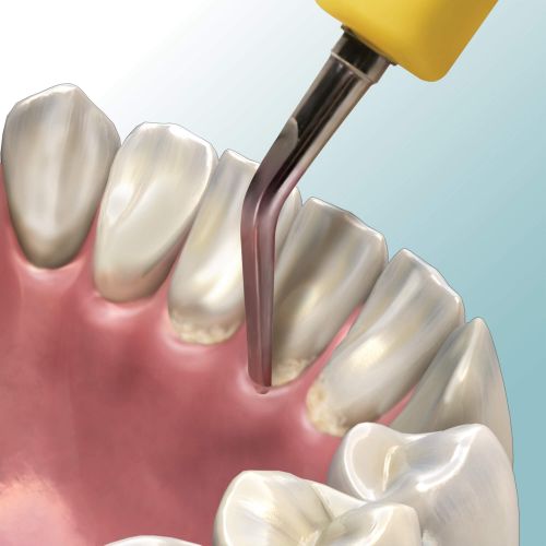 3 Beavertail Streamline™ Ultrasonic Insert UI325K | HuFriedy Group